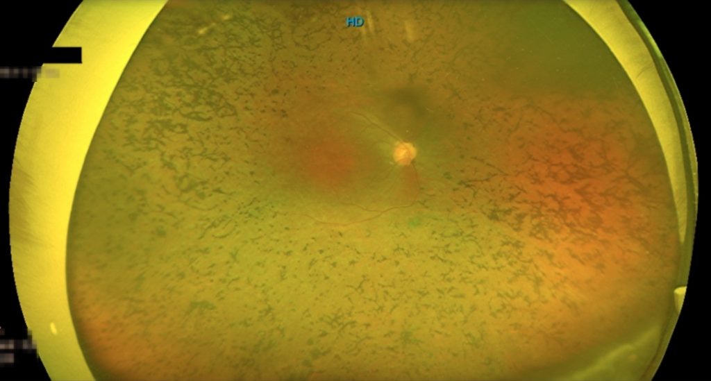 Retinitis Pigmentosa – Oculogénetica Genética Ocular Tratamiento de ...